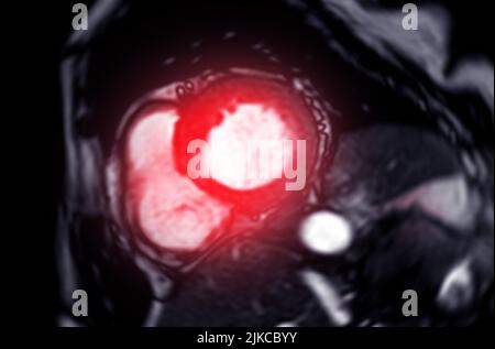 MRI heart or Cardiac MRI in short axis view showing cross-sections of ...