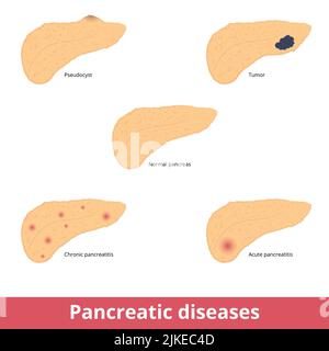 Pancreas health, chronic diseases vector illustration. Cartoon tiny ...