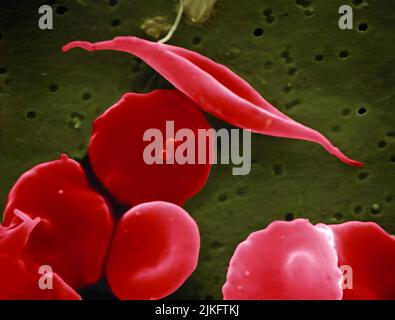 Sickle cell anemia disease (SCD) blood cells 3D illustration Stock ...
