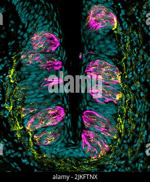 Cancer of the tongue Stock Photo - Alamy