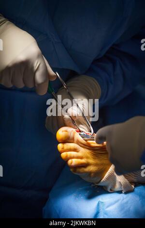 Bunion surgery. Close-up of surgeons inserting metal screws during ...