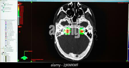 Closeup of a computer axial tomography scan (CAT scan) of a head Stock ...