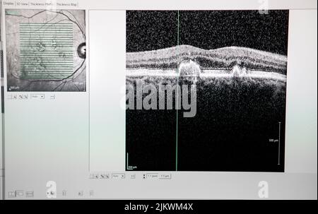 Macular degeneration. Optical coherence tomography (OCT) scan of a ...