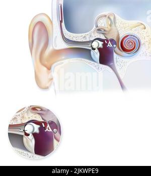 Ear: hearing aid (Esteem) implantable in the inner ear Stock Photo - Alamy