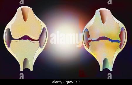 Healthy knee anatomy, degenerative arthritis of the knee and ...