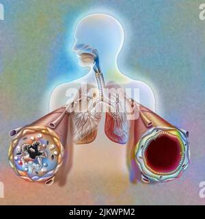 Chronic obstructive pulmonary disease. Artwork of the bronchi of the ...