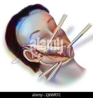 Transplant of a new face onto the facial skeleton of a patient Stock ...