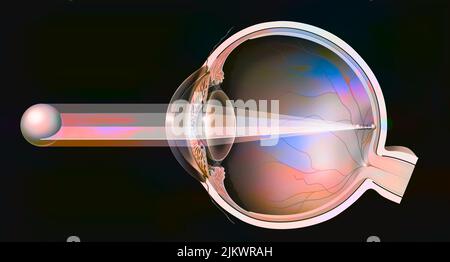 Astigmatic eye (ovoid and non-spherical cornea) inducing distorted ...