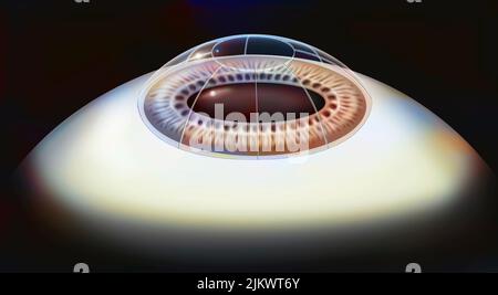 Eye, surgery, radial keratotomy: corneal incisions with a diamond knife ...
