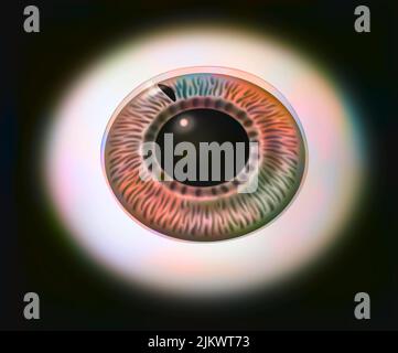 Glaucoma: the iris of one eye to show the laser iridectomy procedure ...