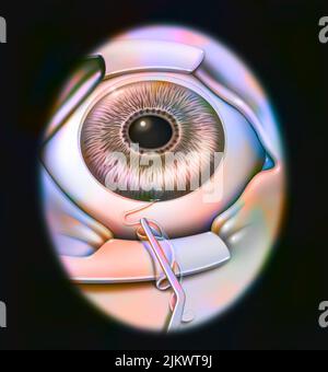 Eye, intraocular implant, step 2: the intraocular implant is folded ...