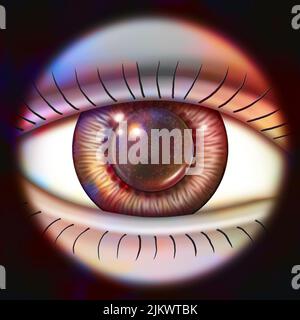 Eye (secondary cataract): clouding of the posterior lens capsule Stock ...