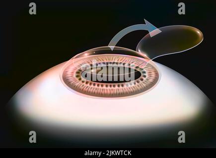 Eye, surgery, Lasik step 4: the corneal flap is put back in place Stock ...