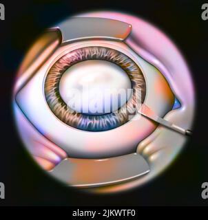 Eye, cataract, phacoemulsification - step 1: making the self-sealing ...