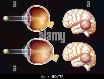 Eye: comparison between a normal eye and a myopic, hyperopic ...