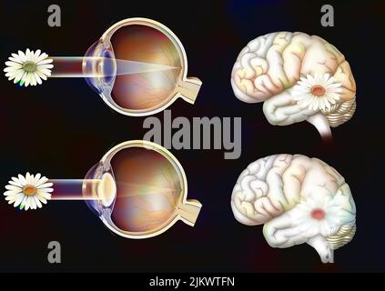 Comparison between normal vision and that of an eye with cataract Stock ...