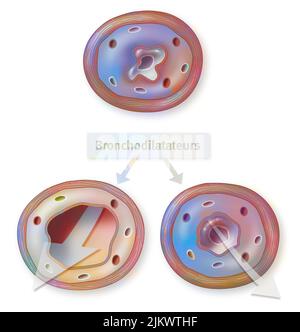Chronic obstructive pulmonary disease. Artwork of the bronchi of the ...