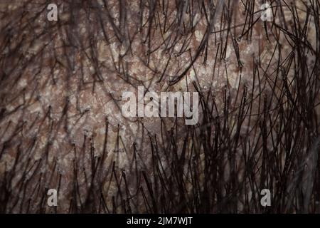 dry flaky skin on back of teenage girl Stock Photo - Alamy