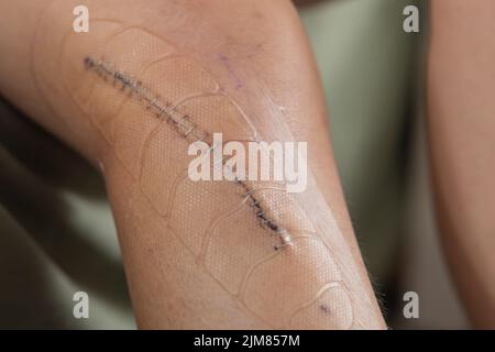 Fresh wound with stitches after skin operation. Removal of skin tumors ...