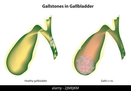 Gallstones. Cholelithiasis. Cholecystitis. Inflammation of the ...