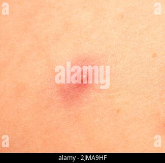 Pustule acne. Close up pimple on female skin. Dermatology, puberty ...