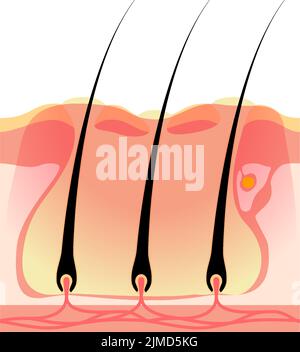 Illustration of a "carbuncle," a subcutaneous connection of multiple ...