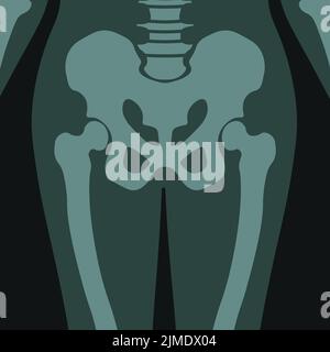 XRay of hip joint pelvis human bones anatomy orthopedic medical ...