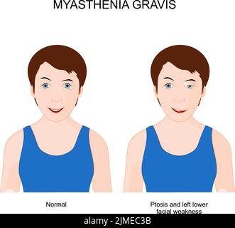Myasthenia gravis. An autoimmune disease of the neuromuscular junction ...