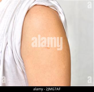 BCG or TB vaccine scar mark at the arm of Southeast Asian man Stock ...