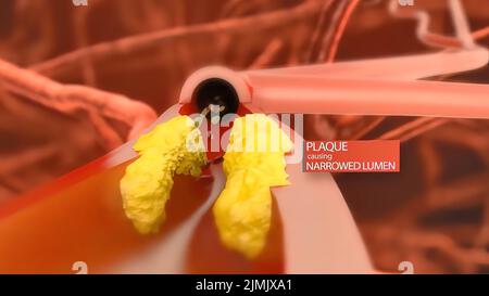 Heart Stent angioplasty. Stent and catheter for implantation into blood ...