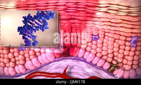 Squamous cell carcinoma skin cancer. Close-up of a squamous cell ...