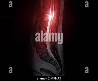 MRI Lumbar spine sagittal T2W Fat suppression Stock Photo - Alamy