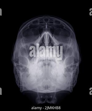 X-ray image of Human Skull Water's view for diagnosis skull fracture ...