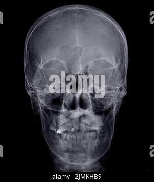 Skull x-ray image of Human name is skull towne's view .isolated on ...