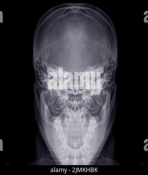 Skull x-ray image of Human name is skull AP view .isolated on Black ...