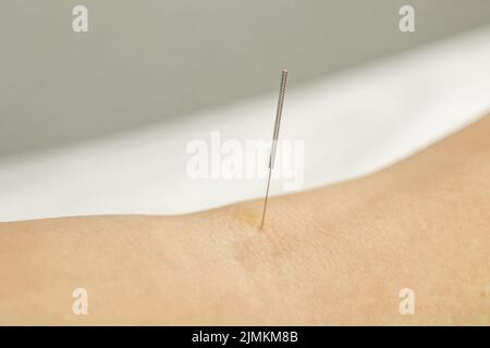 Therapy of female leg with acupuncture needles Stock Photo - Alamy