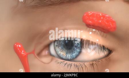 Lacrimal abscess. Close-up of a lacrimal abscess under a patient's eye ...