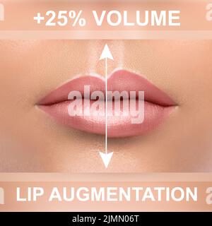 Big sensual lips after procedure lip augmentation. Beautician injects ...
