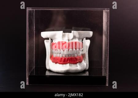 Human jaw with teeth implants anatomy model isolated on black ...