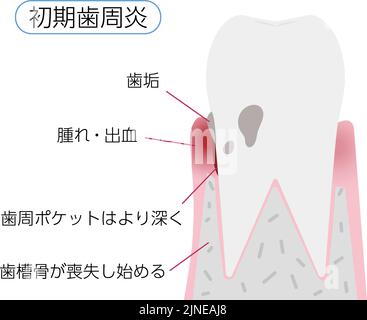 Illustration by stage of periodontal disease: early periodontitis Stock ...