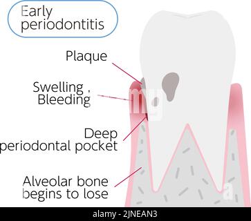 Illustration by stage of periodontal disease: early periodontitis ...