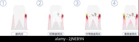 The stages of periodontitis disease vector illustration Stock Vector ...