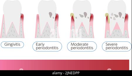 Illustration by stage of periodontal disease: order of progress ...