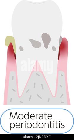 Illustration by stage of periodontal disease: moderate periodontitis ...