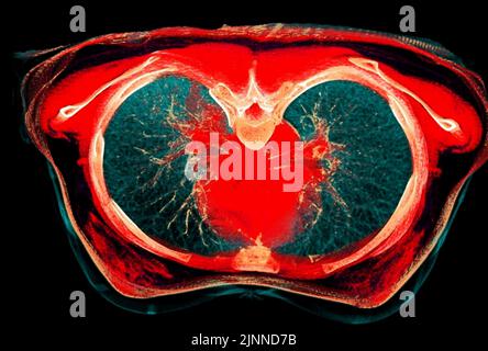 Normal lung, CT scan Stock Photo - Alamy