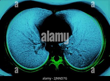 Normal lung, CT scan Stock Photo - Alamy
