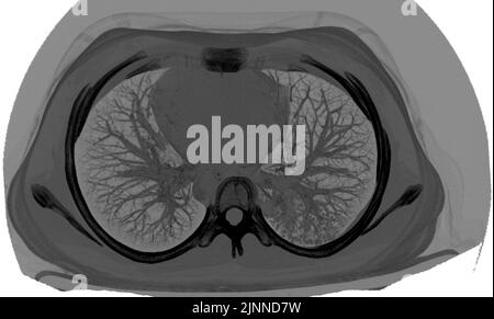 Normal lung, CT scan Stock Photo - Alamy