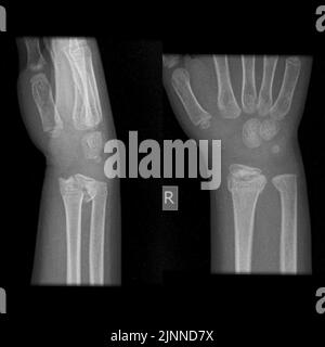 Growth plate fracture, X-ray Stock Photo - Alamy