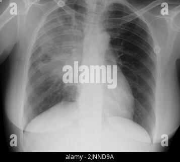 Lung abscess, X-ray Stock Photo - Alamy