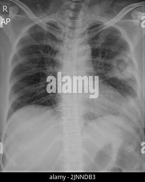 Lung abscess, X-ray Stock Photo - Alamy